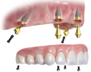 All-on-4 vs All-on-6 - LBR Dental & Implant Center