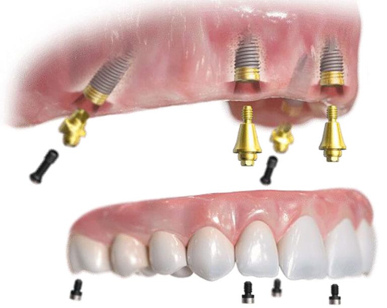 All-on-4 vs All-on-6 - LBR Dental & Implant Center