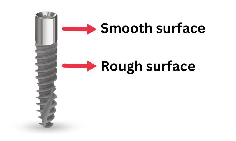 Immediate Loading Implants Explained: Fixed Teeth Without Delay - LBR ...